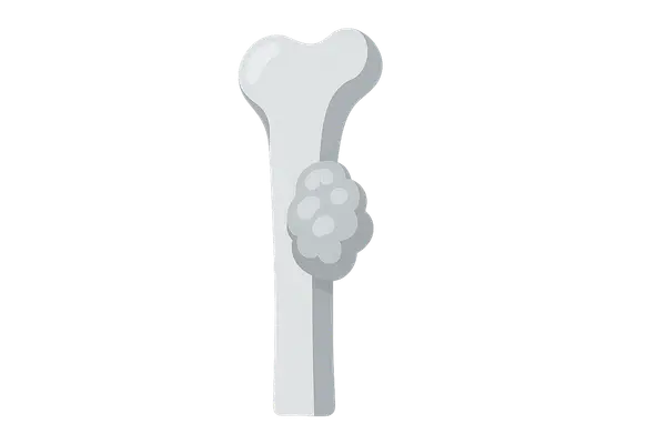 Benign Bone Tumors | Bone Tumors - OnCourse NEET-PG